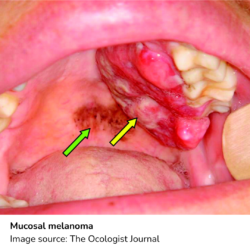 What is Mucosal Melanoma - Melanoma Canada
