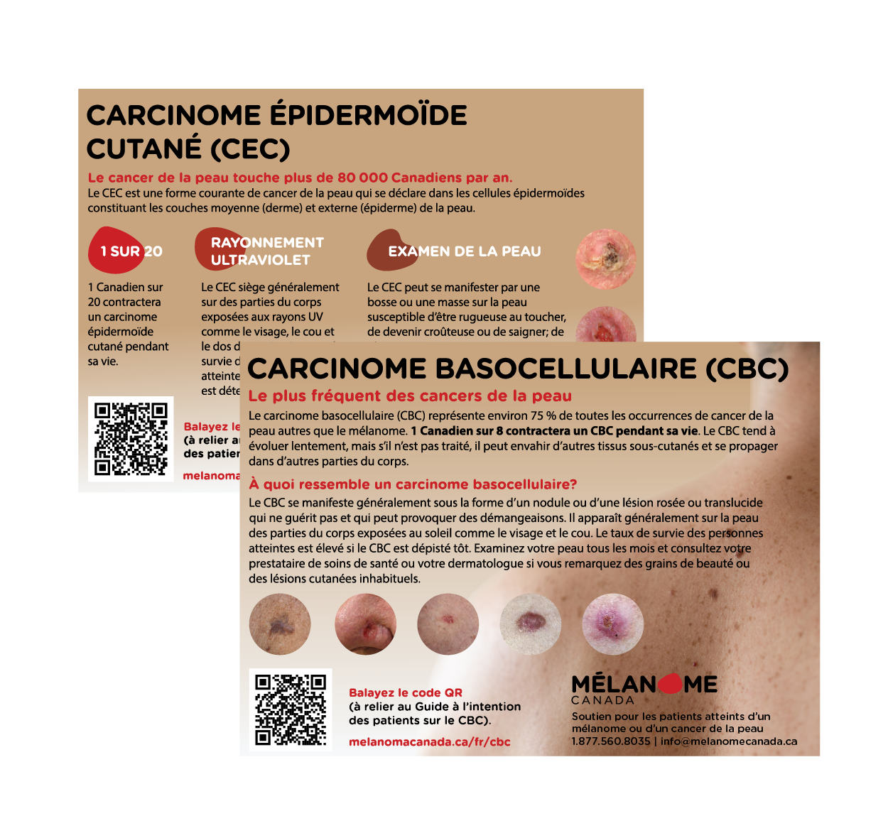 Soutien et ressources - Melanoma Canada