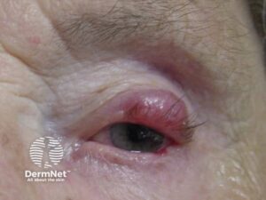 Images of Merkel Cell Carcinoma - Melanoma Canada