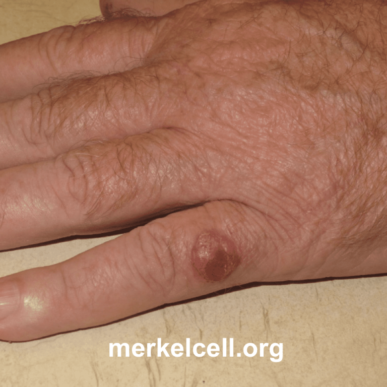 Images of Merkel Cell Carcinoma - Melanoma Canada
