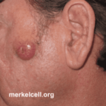 Images of Merkel Cell Carcinoma - Melanoma Canada
