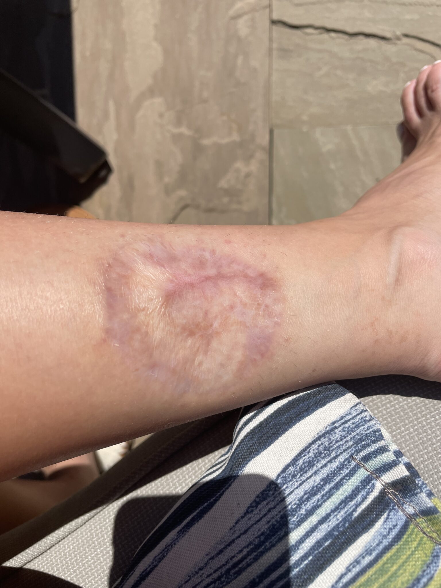 Marked by Strength: What Skin Cancer Taught Me About Life - Melanoma Canada